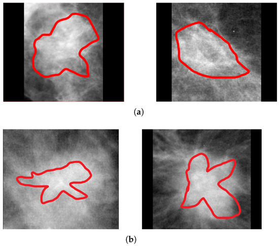 Architectural Distortion-Based Digital Mammograms Classification Using ...