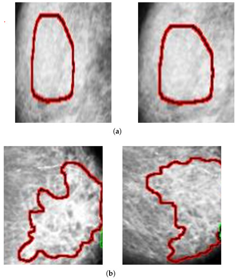 Architectural Distortion-Based Digital Mammograms Classification Using ...