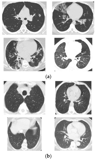 CGENet: A Deep Graph Model for COVID-19 Detection Based on Chest CT
