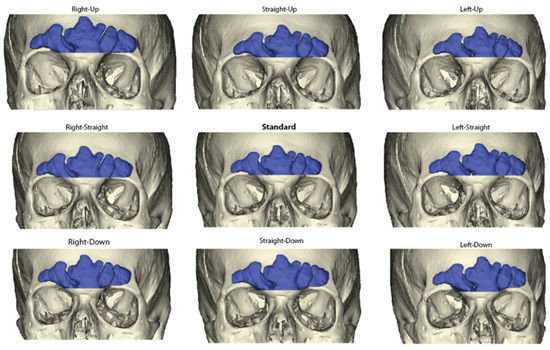 The Effects of Cranial Orientation on Forensic Frontal Sinus ...