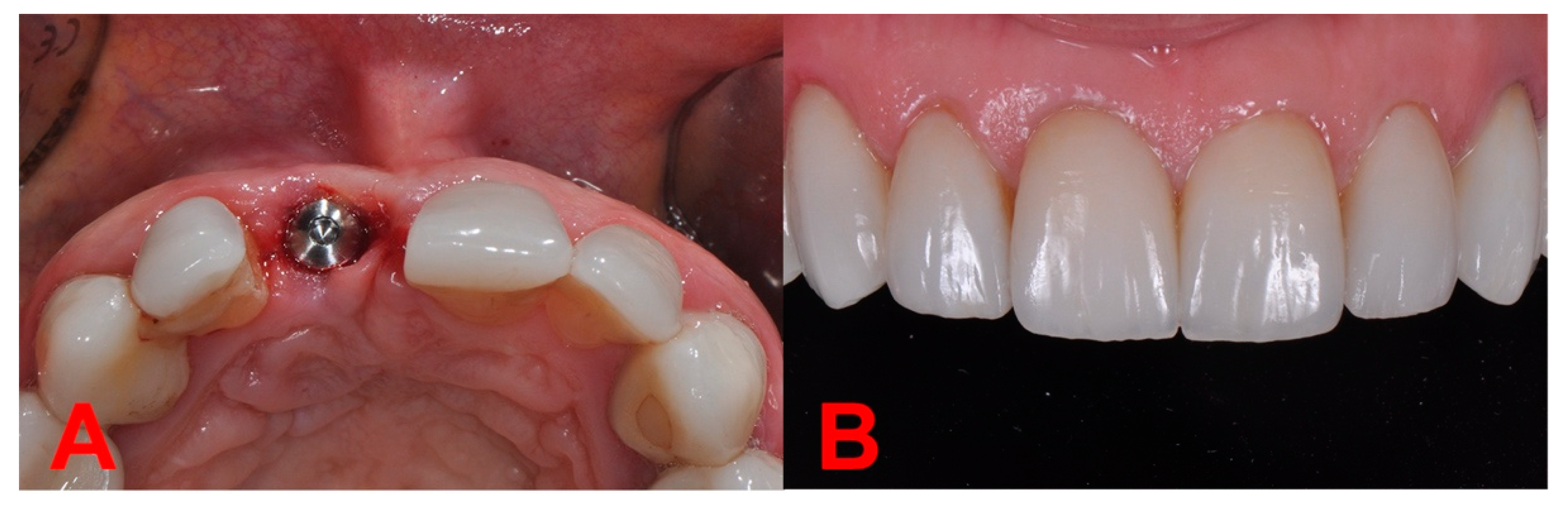 Biology | Free Full-Text | Open Healing: A Minimally Invasive Protocol with Flapless Ridge ...