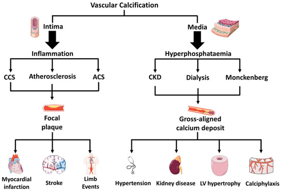 Cardiac Calcifications: Phenotypes, Mechanisms, Clinical and Prognostic ...