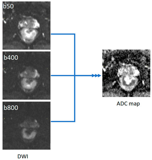 The Utility of ADC First-Order Histogram Features for the Prediction of ...