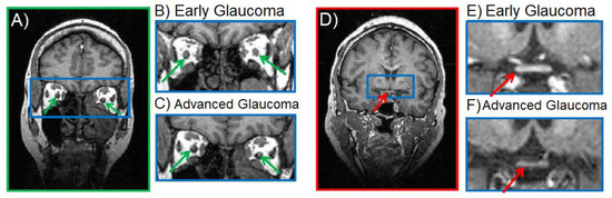 Advanced Diffusion MRI of the Visual System in Glaucoma: From ...
