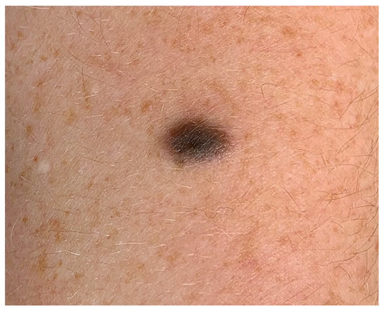 Conventional and Atypical Deep Penetrating Nevus, Deep Penetrating ...