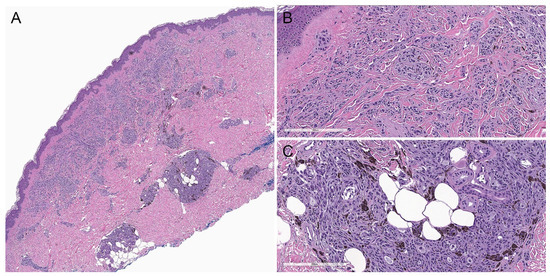 Conventional and Atypical Deep Penetrating Nevus, Deep Penetrating ...