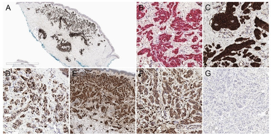 Conventional and Atypical Deep Penetrating Nevus, Deep Penetrating ...