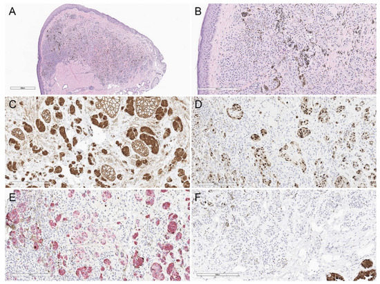 Conventional and Atypical Deep Penetrating Nevus, Deep Penetrating ...
