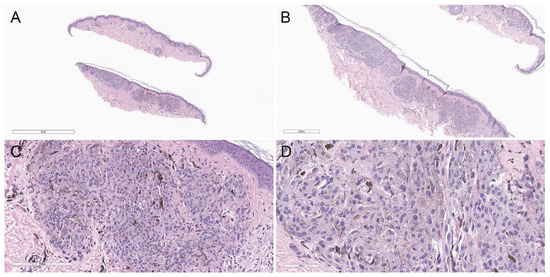Conventional and Atypical Deep Penetrating Nevus, Deep Penetrating ...