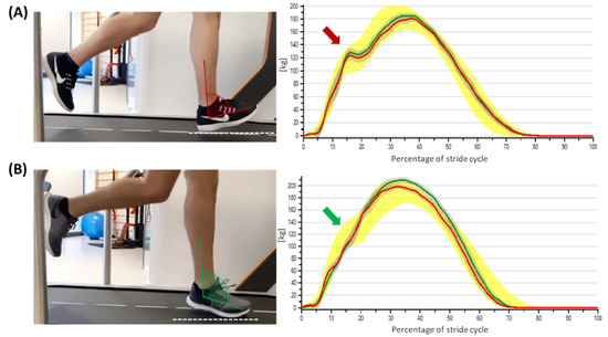 Running Footwear and Impact Peak Differences in Recreational Runners