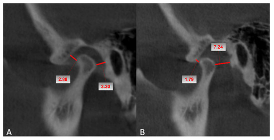 Evaluation of the Mandibular Condyle Morphologic Relation before and ...