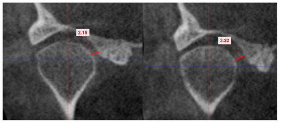 Evaluation of the Mandibular Condyle Morphologic Relation before and ...