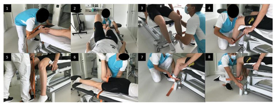 Evolution of Hip Muscles Strength in Femoroacetabular Impingement ...