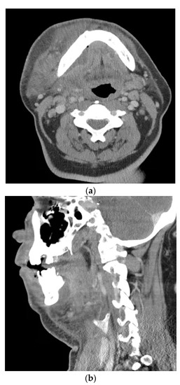 Complications of Severe Odontogenic Infections: A Review