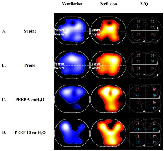 Pathophysiology and Clinical Meaning of Ventilation-Perfusion Mismatch ...