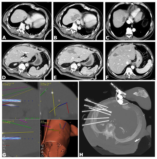 Reliability of Stereotactic Radiofrequency Ablation (SRFA) for Malignant Liver Tumors: Novice ...