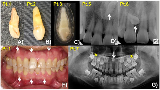Rare Variants in LRP4 Are Associated with Mesiodens, Root ...