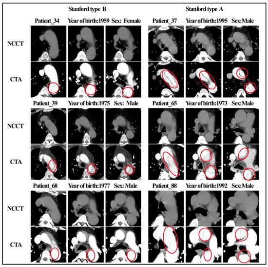 Diagnosis of Acute Aortic Syndromes on Non-Contrast CT Images with ...