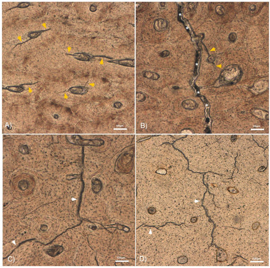 Osteonal Microcracking Pattern: A Potential Vitality Marker in Human ...