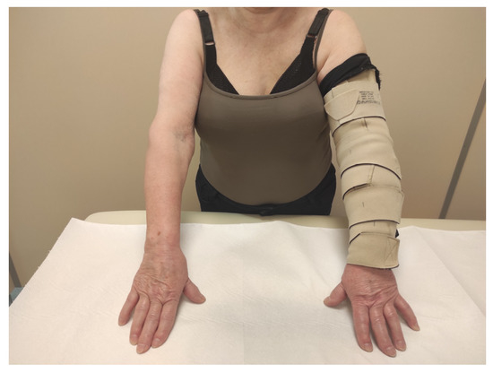 Severe Lymphedema Arm