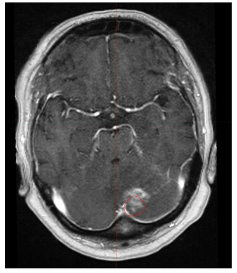 Radiation Necrosis Following Stereotactic Radiosurgery or Fractionated ...