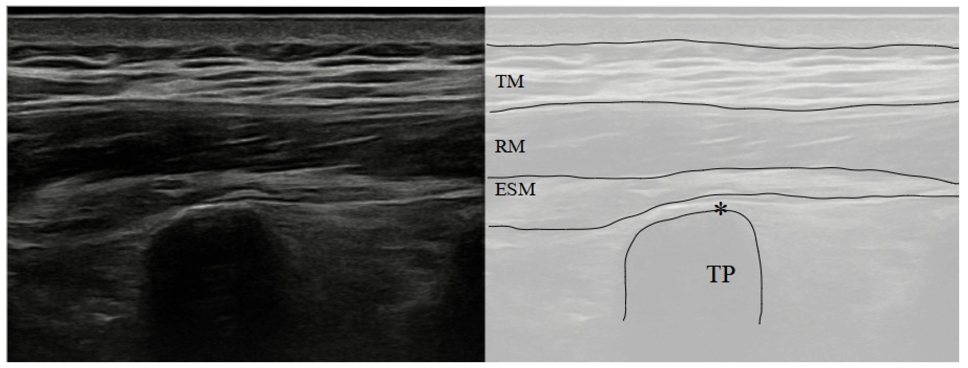 Erector Spinae Plane Block and Chronic Pain: An Updated Review and ...