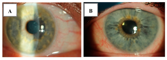 Matrix Metalloproteinases and the Pathogenesis of Recurrent Corneal ...