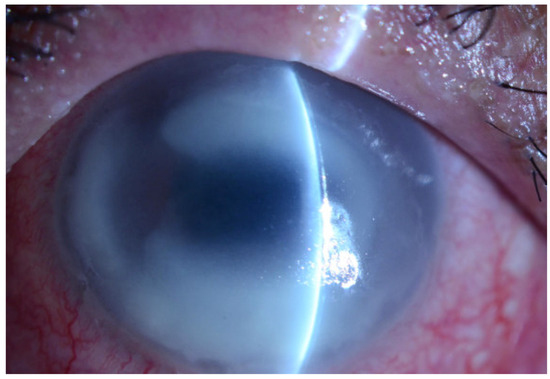 New Frontiers in Acanthamoeba Keratitis Diagnosis and Management