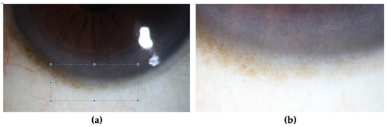 A Review of Contact Lens-Induced Limbal Stem Cell Deficiency