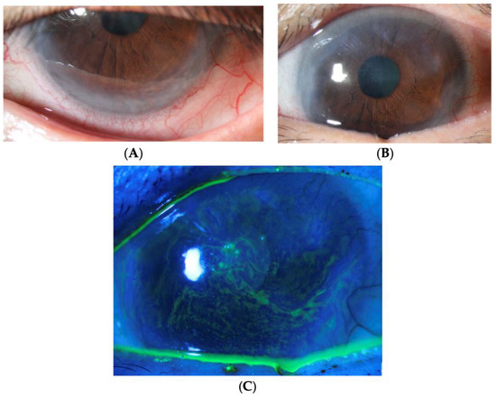 A Review of Contact Lens-Induced Limbal Stem Cell Deficiency