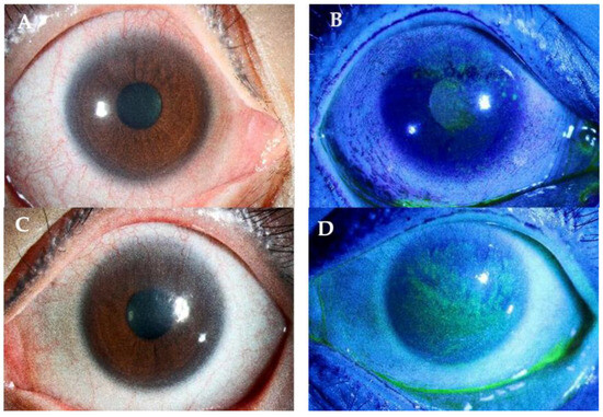 A Review of Contact Lens-Induced Limbal Stem Cell Deficiency