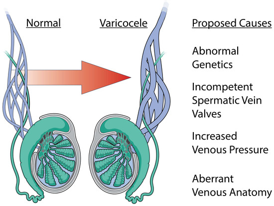 The Evolving Landscape Of Male Varicocele Pathophysiology In The Era Of