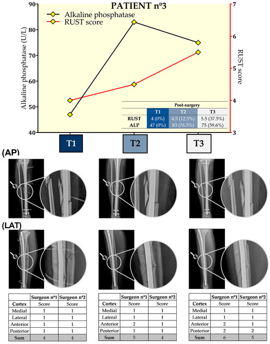 Comparison of Radiographic Outcomes Assessed via the Radiographic Union ...