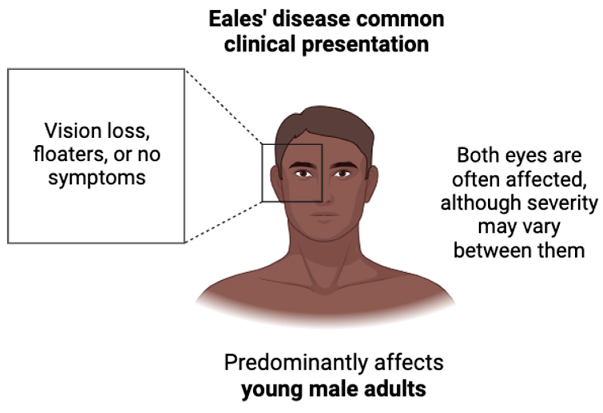 A Review of Eales’ Disease and Mycobacterium tuberculosis