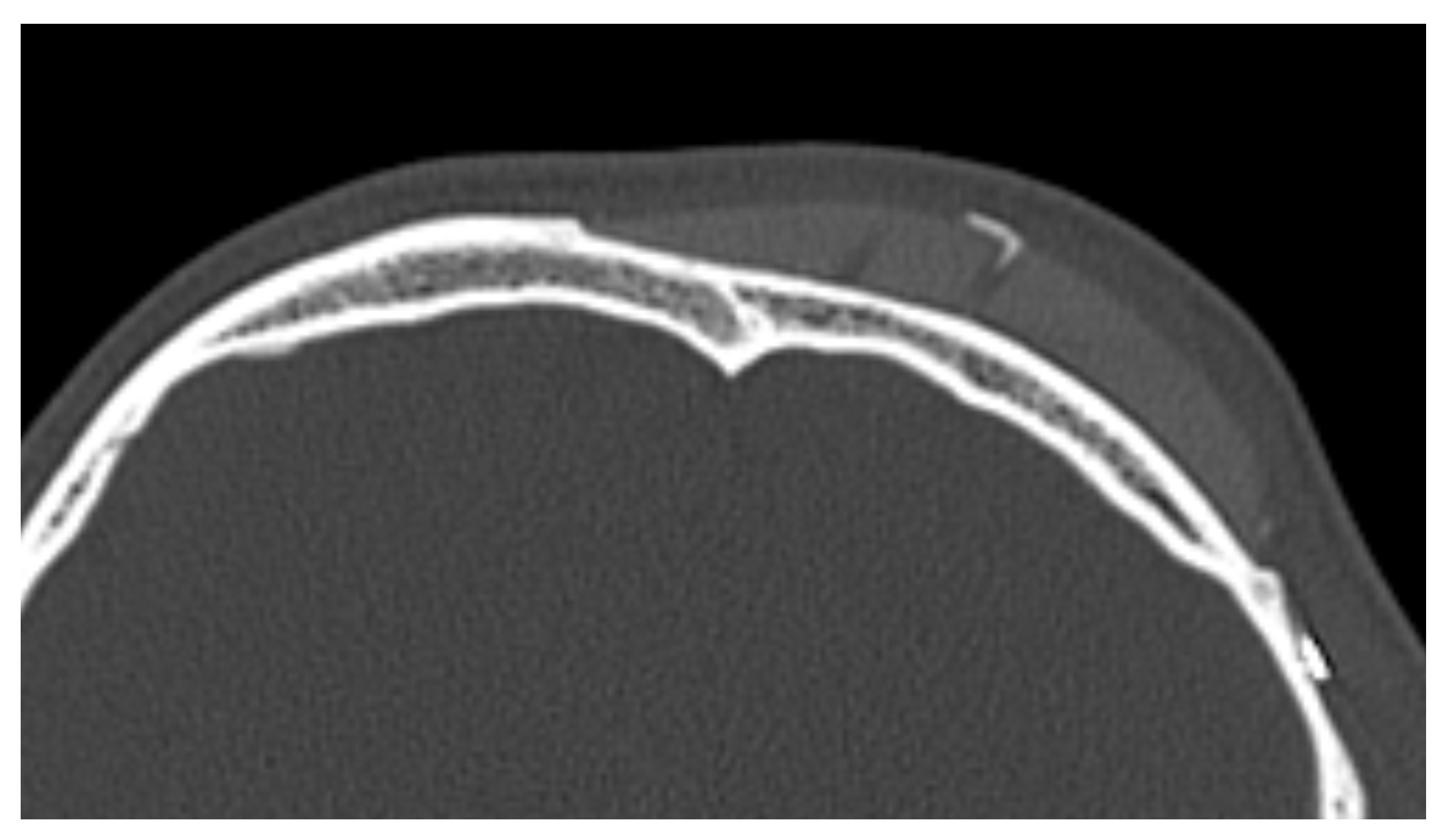 Bone Regeneration and Polyetheretherketone Implants in Maxillo-Facial ...