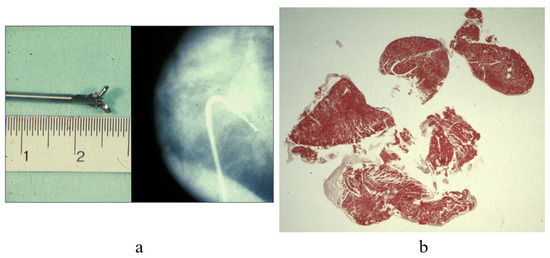 Storytelling of Myocardial Biopsy