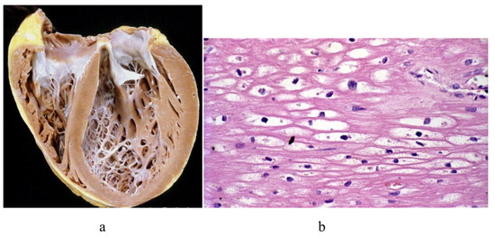 Storytelling of Myocardial Biopsy