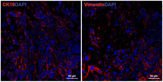 Precision Medicine: IL-1RA and Pancreatic Cancer Organoids