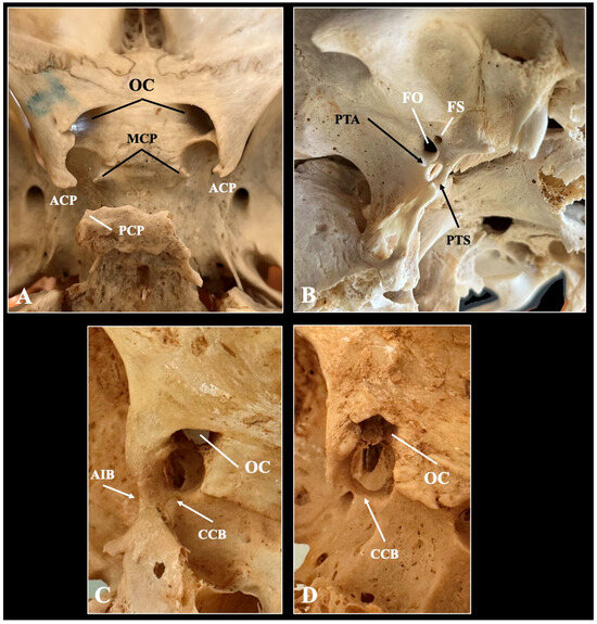 The Developing Human Sphenoid Bone: Linking Embryological Development ...