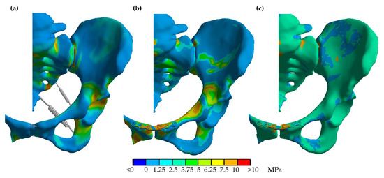 Comparative Finite Element Analysis of Fixation Techniques for APC II ...