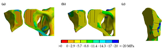 Comparative Finite Element Analysis of Fixation Techniques for APC II ...