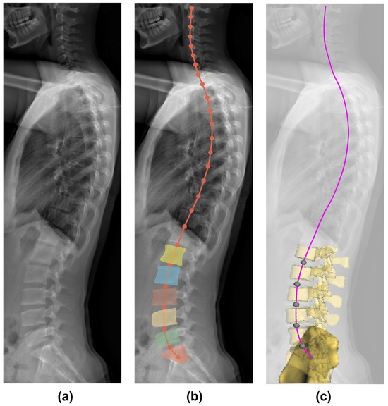 A Simple, Efficient Method for an Automatic Adjustment of the Lumbar ...
