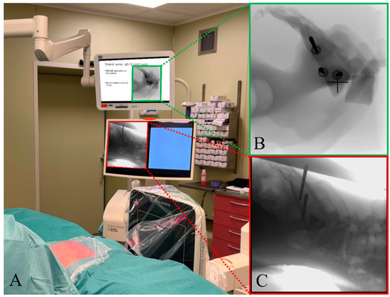 Patient-Specific 3D Virtual Surgical Planning Using Simulated ...