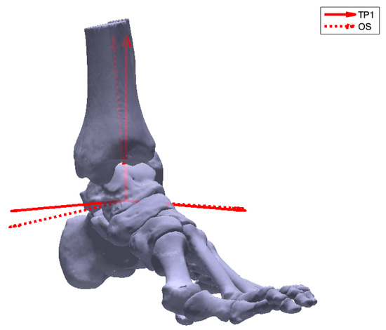 Definition of a Global Coordinate System in the Foot for the Surgical ...