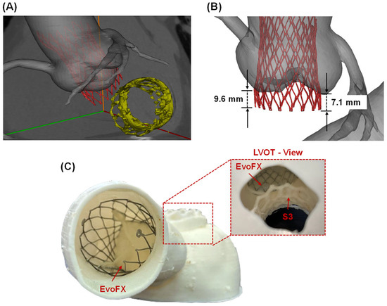 Augmented Reality and Computational Simulations for the Preprocedural ...