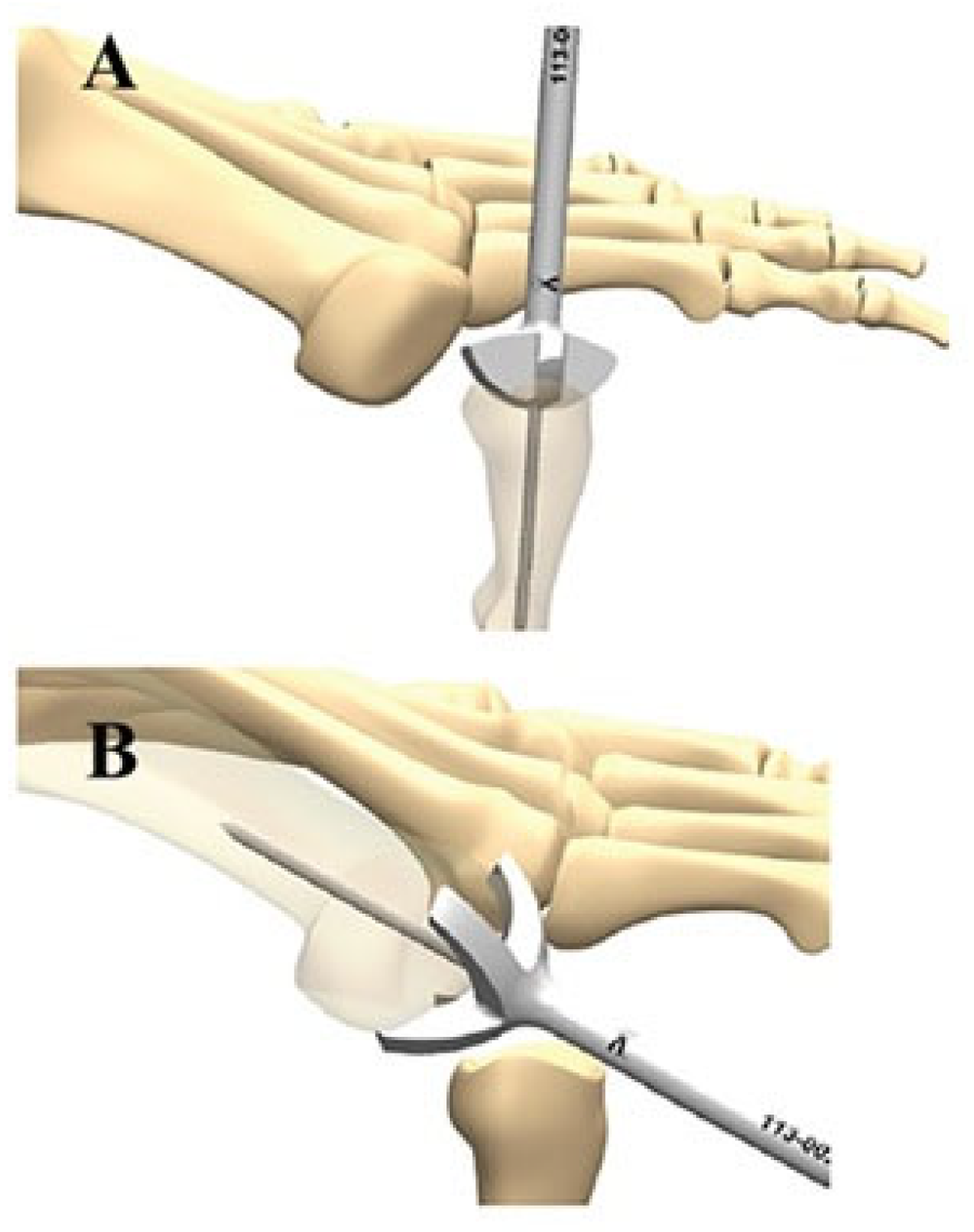 Increased Risk for Non-Union in First Metatarsophalangeal Joint ...
