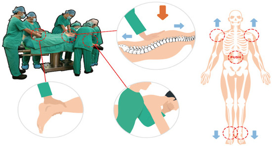 Manual Reduction for Subacute Osteoporotic Burst and Severe Compression ...