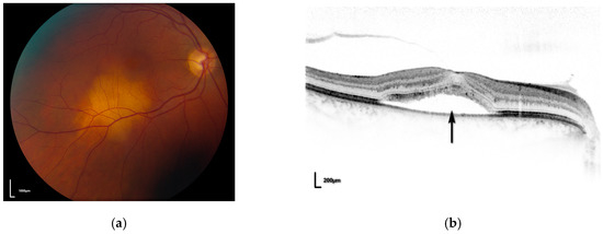 Photodynamic Therapy for Eye Cancer
