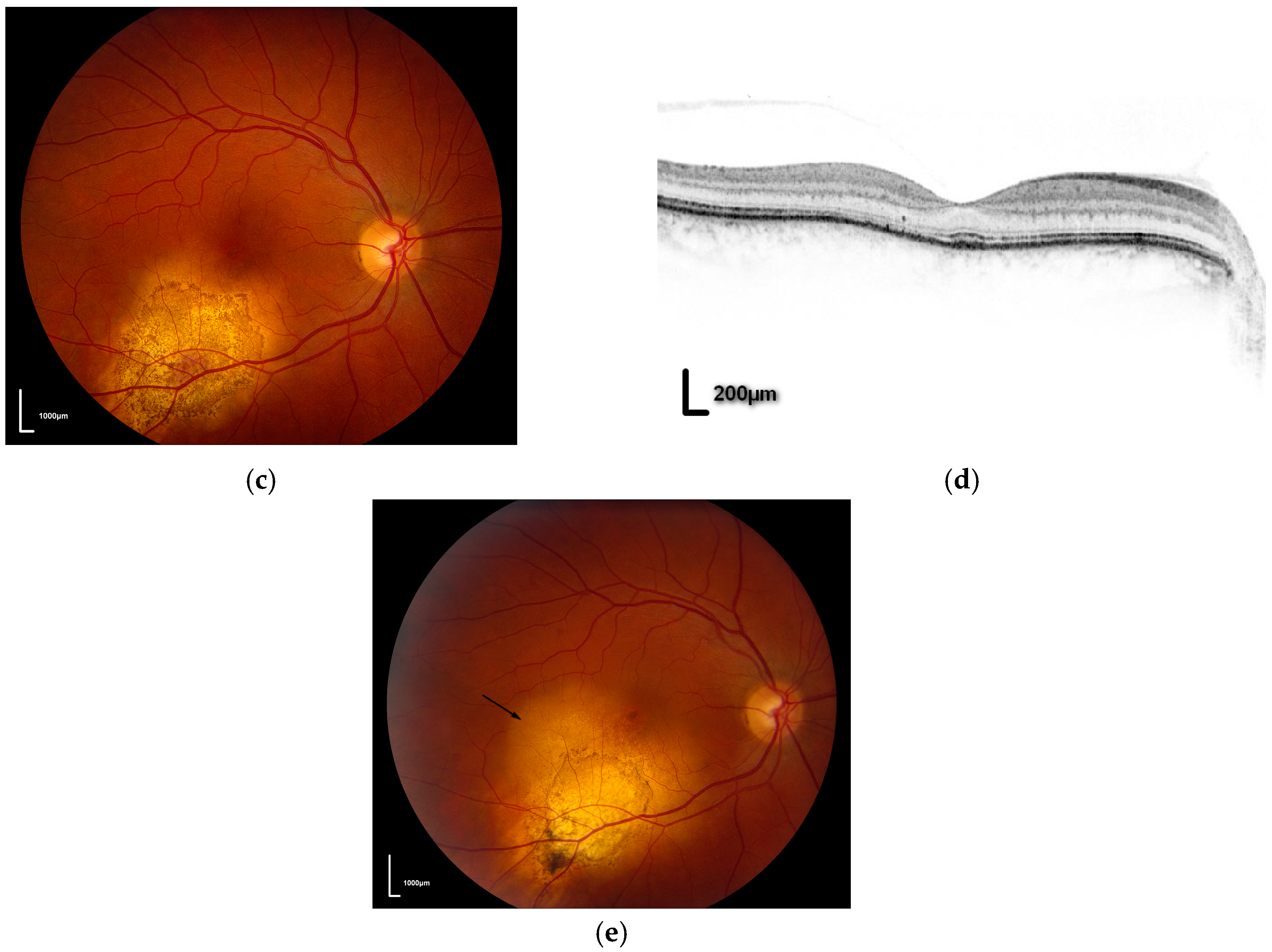 Photodynamic Therapy for Eye Cancer