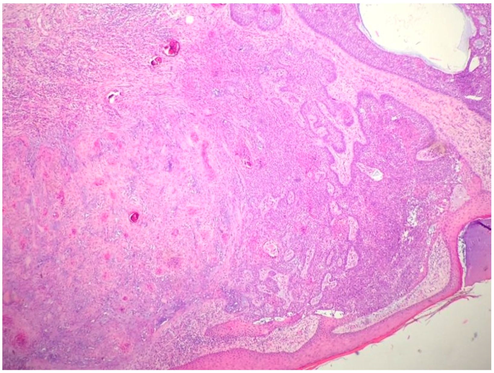 Morpheaform Basal Cell Carcinoma Histology